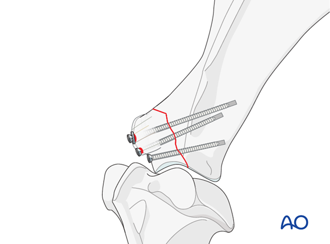 Screw fixation for Supraglenoid tubercle fractures