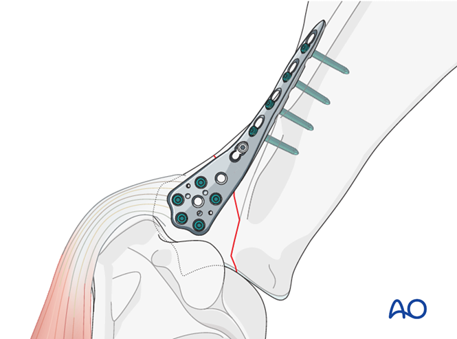 Plate fixation for Supraglenoid tubercle fractures