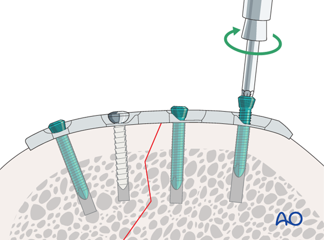 Plate fixation for Supraglenoid tubercle fractures