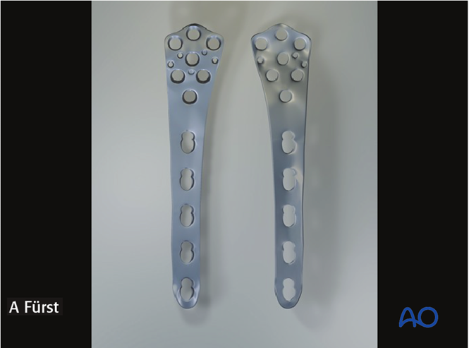 Plate fixation for Supraglenoid tubercle fractures