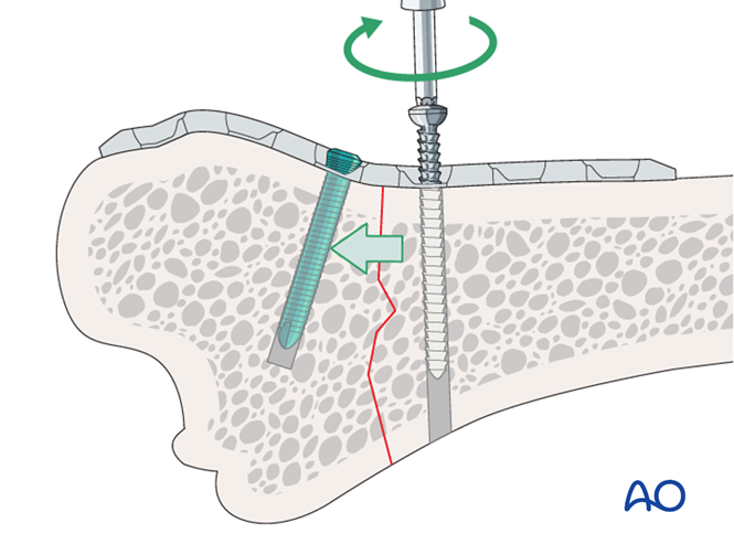 Plate fixation for Scapular neck fractures