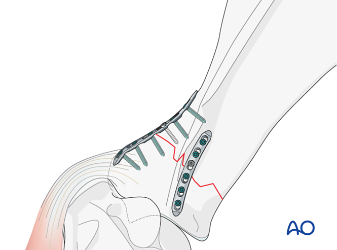 Plate fixation for Scapular neck fractures