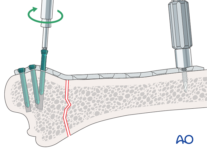 Plate fixation for Scapular neck fractures