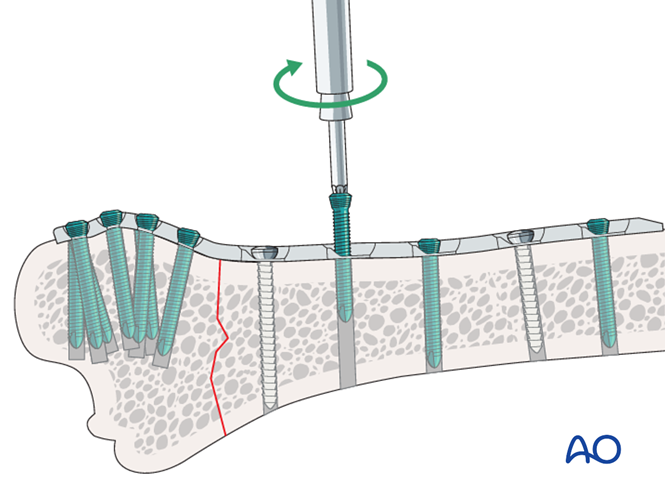 Plate fixation for Scapular neck fractures