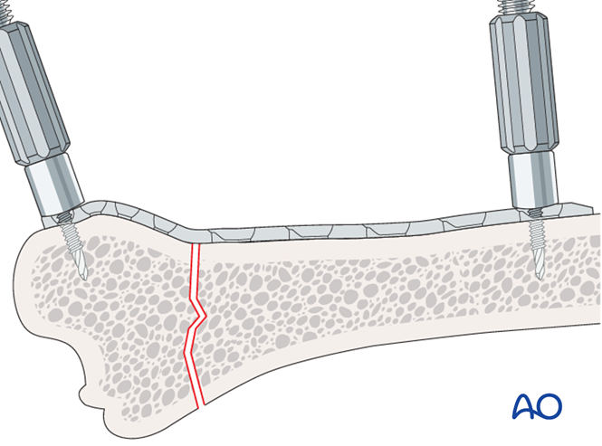Plate fixation for Scapular neck fractures