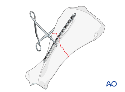 Plate fixation for Scapular body fractures