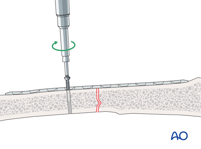 Plate fixation for Scapular body fractures