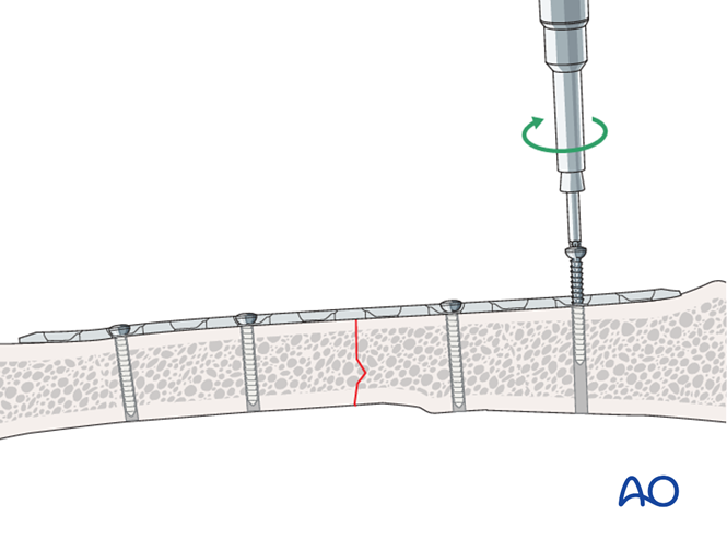 Plate fixation for Scapular body fractures