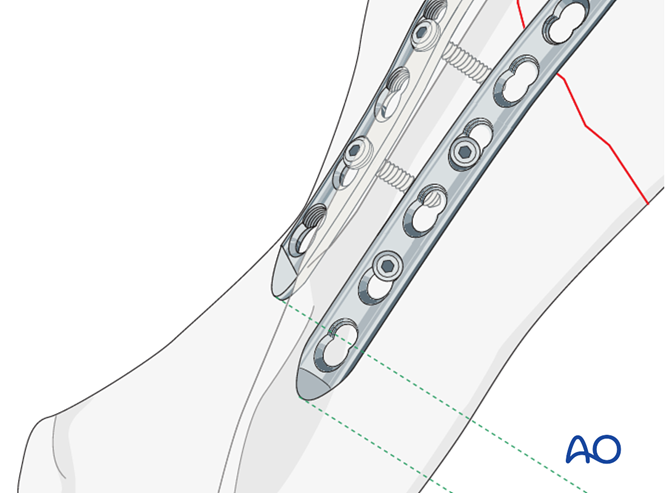 Plate fixation for Scapular body fractures