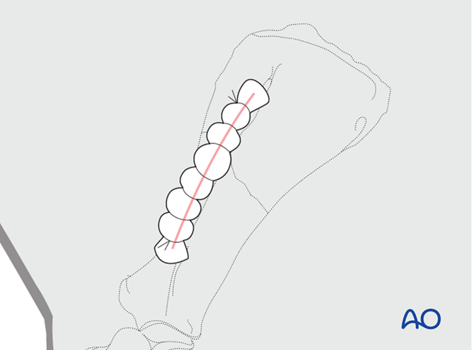 Plate fixation for Scapular body fractures