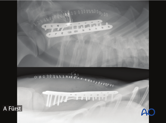Plate fixation for Scapular body fractures