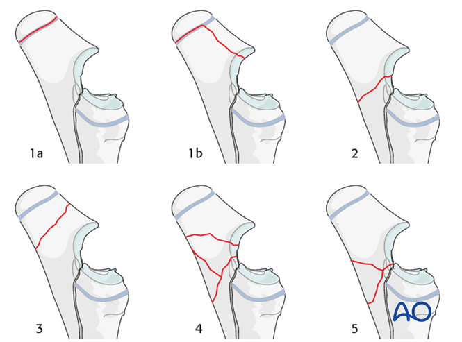 Introduction to ulnar fractures