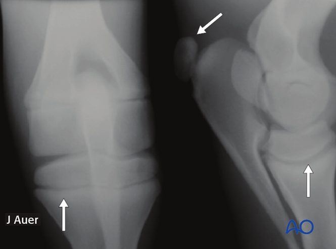 Ulnar fractures: anatomical considerations