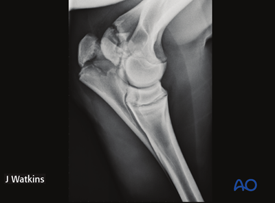 Type 1b olecranon fractures