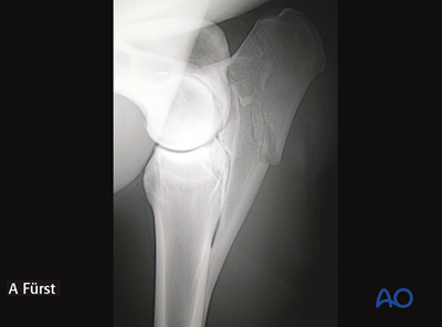 Type 3 olecranon fractures
