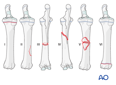Introduction to radial fractures