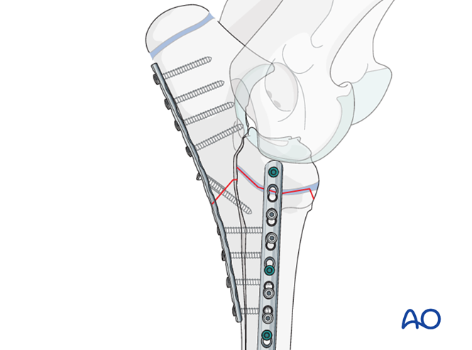 Double plate fixation for Radius: Proximal physeal fractures
