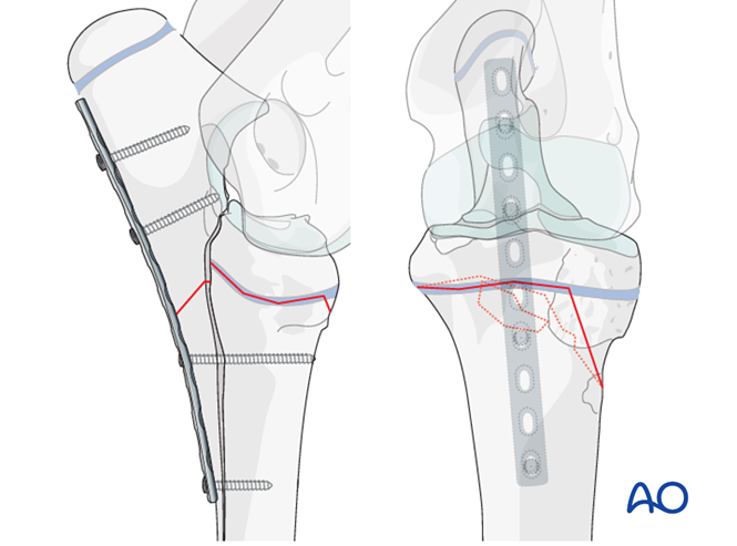 Double plate fixation for Radius: Proximal physeal fractures