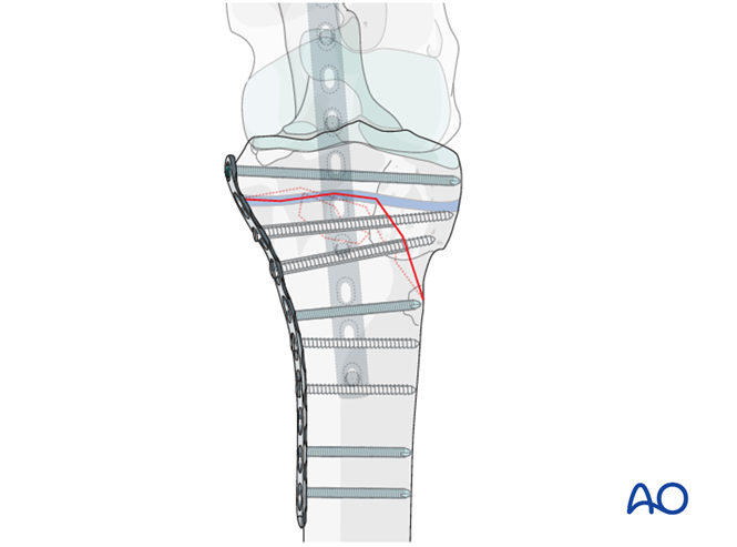 Double plate fixation for Radius: Proximal physeal fractures