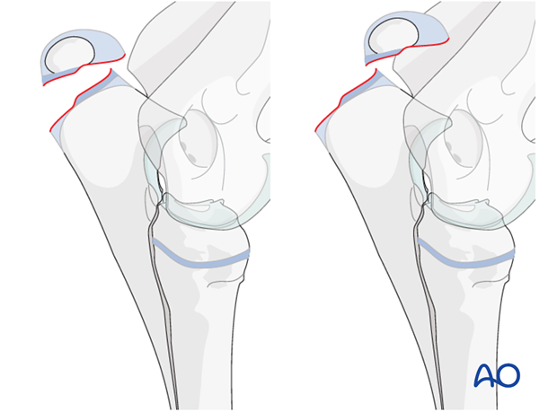 Type 1a olecranon fractures