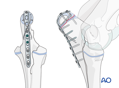 Plate fixation for Olecranon: Type 1a fractures