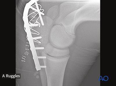 Plate fixation for Olecranon: Type 1a fractures