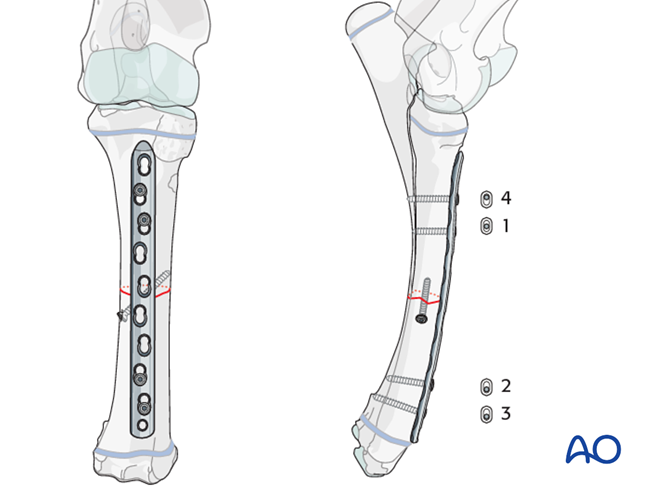 Plate fixation for Radius: Mid-diaphyseal transverse fractures