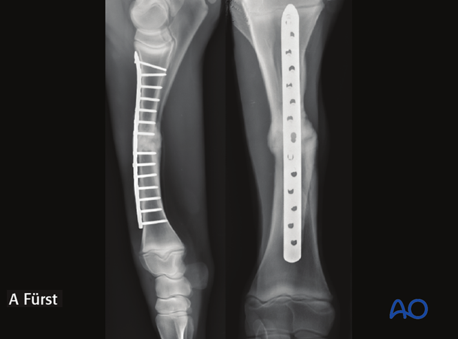 Plate fixation for Radius: Mid-diaphyseal transverse fractures