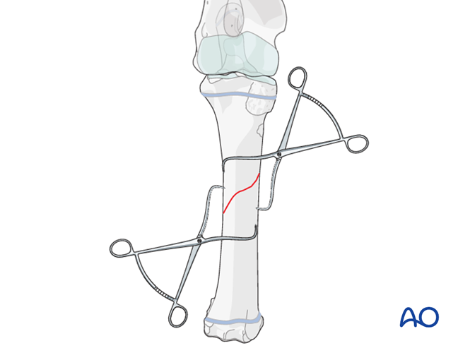 Double plate fixation for Radius: Diaphyseal simple fractures