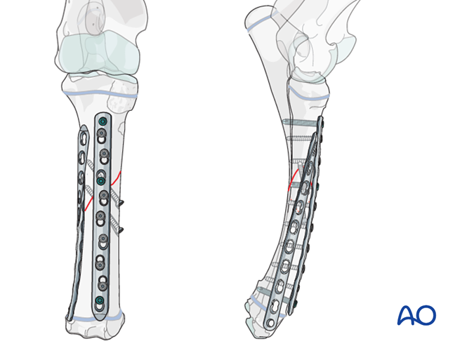 Double plate fixation for Radius: Diaphyseal simple fractures