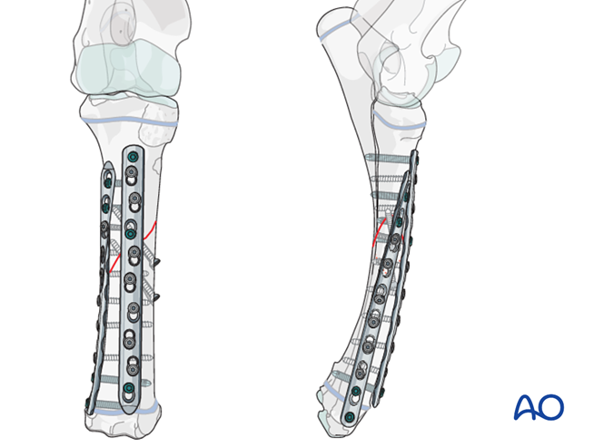 Double plate fixation for Radius: Diaphyseal simple fractures