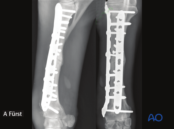 Double plate fixation for Radius: Diaphyseal comminuted fractures
