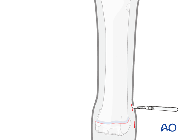 Transphyseal bridge for Radius: Distal physeal fractures