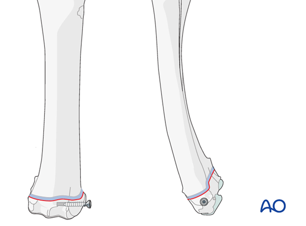 Transphyseal bridge for Radius: Distal physeal fractures