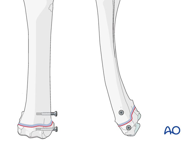 Transphyseal bridge for Radius: Distal physeal fractures