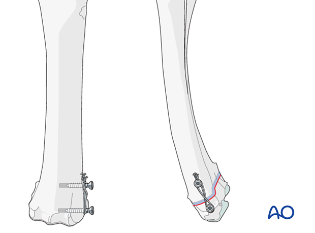 Transphyseal bridge for Radius: Distal physeal fractures