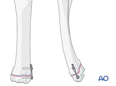 Transphyseal bridge for Radius: Distal physeal fractures