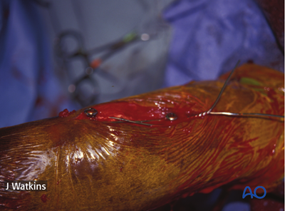 Transphyseal bridge for Radius: Distal physeal fractures