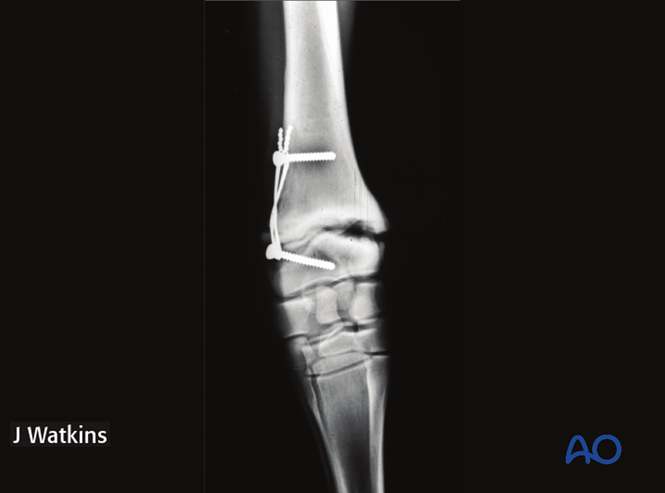 Transphyseal bridge for Radius: Distal physeal fractures