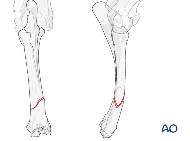 Simple metaphyseal fractures