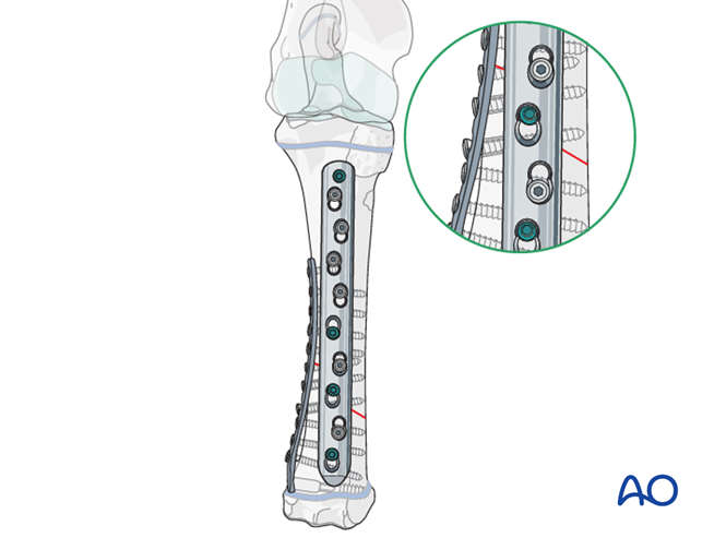 Double plate fixation for Radius: Metaphyseal fractures