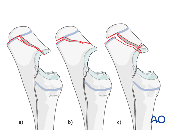 Olecranon Fracture Classification