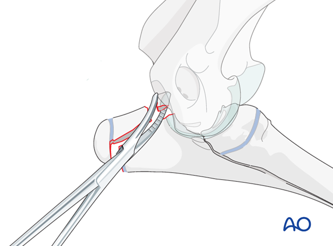 Plate fixation for Olecranon: Type 1b fractures