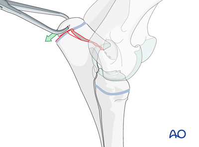 Plate fixation for Olecranon: Type 1b fractures
