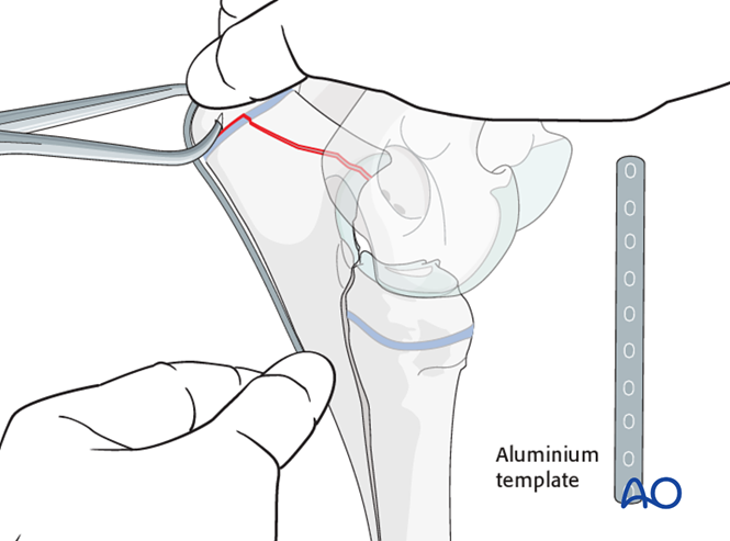 Plate fixation for Olecranon: Type 1b fractures