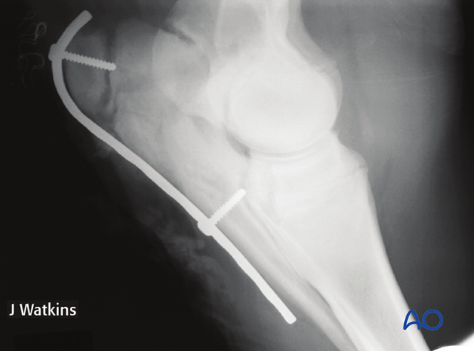 Plate fixation for Olecranon: Type 1b fractures