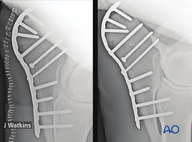 Plate fixation for Olecranon: Type 1b fractures