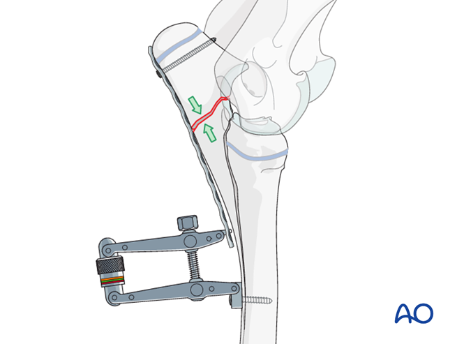 Plate fixation for Olecranon: Type 2 fractures
