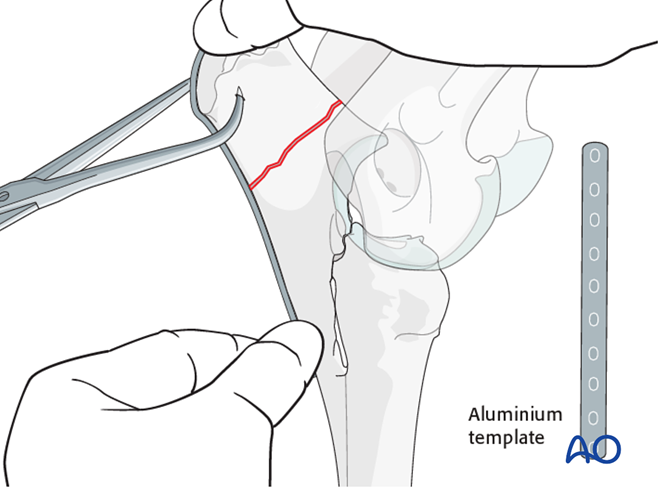 Plate fixation for Olecranon: Type 3 fractures