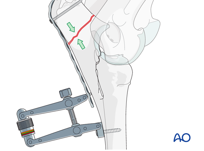 Plate fixation for Olecranon: Type 3 fractures